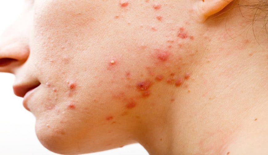 starting on an acne journey – what you need to know – Urba Beauty